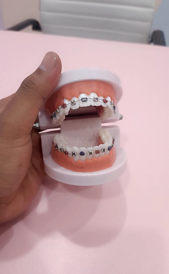 How To Install Brackets on Tooth Models Stock Image - Image of tooth ...