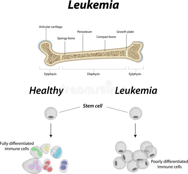Hueso de la leucemia ilustración del vector. Ilustración de leucemia ...