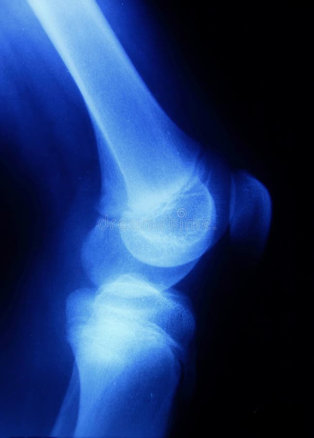Huesos de la rodilla foto de archivo. Imagen de ciencia - 16320158