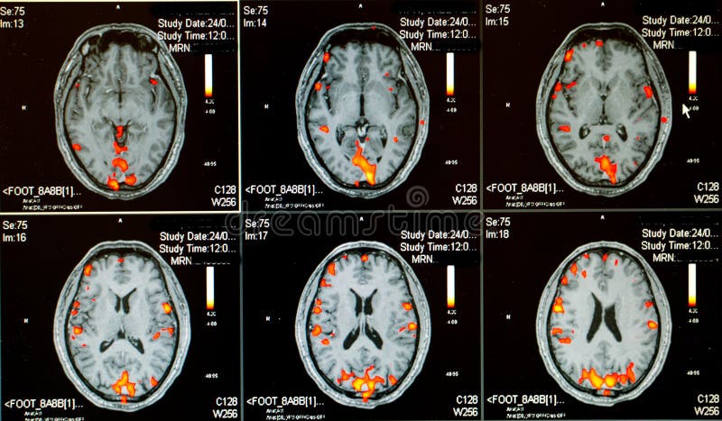 Human active brain imaging stock photo. Image of magnetic - 87602494
