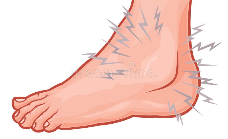 Ankle sprain grading stock vector. Illustration of care - 22281659