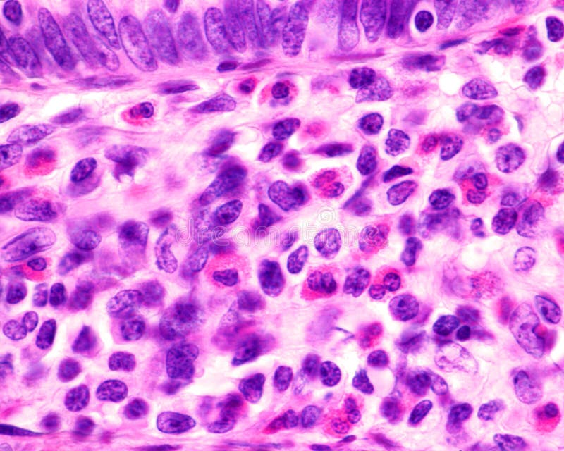 Human Appendix. Eosinophils Stock Photo - Image of microscopy, white ...