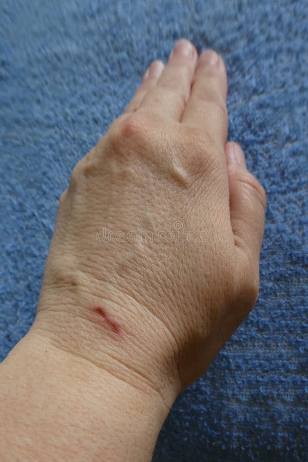 Human Arm with Scar from Injured Skin Stock Image - Image of injured ...