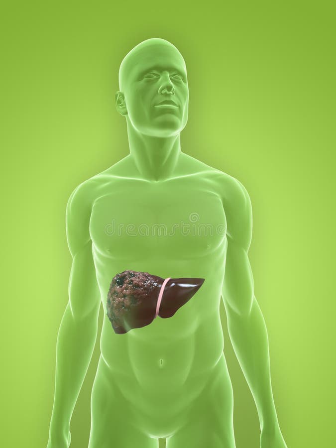 Human bad liver stock illustration. Illustration of organic - 10245599