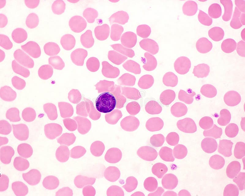 Human Blood Smear. Lymphocyte Stock Image - Image of haematology ...