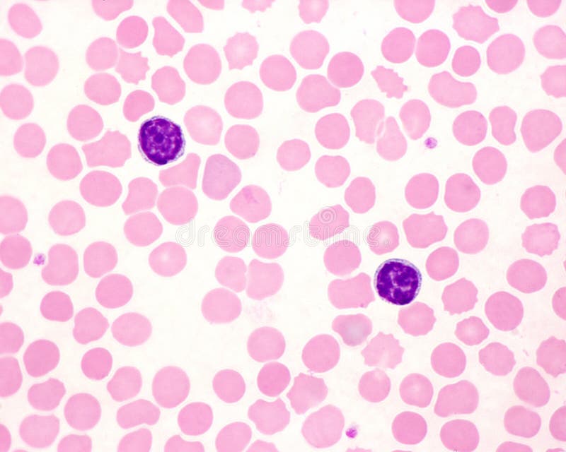 Human Blood Smear. Lymphocytes Stock Photo - Image of lymphocyte ...