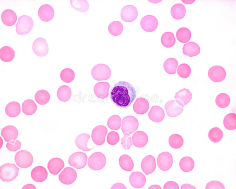 Human Blood Smear. Monocyte Stock Photo - Image of microscopic ...