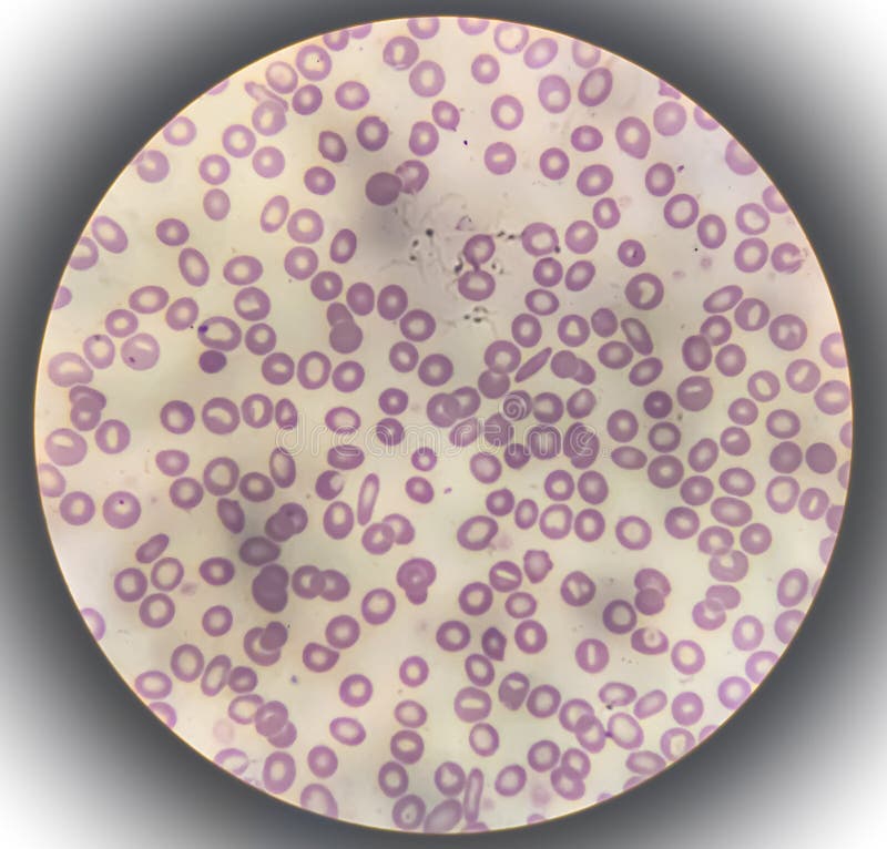 Abnormal Red Blood Cells Showing Spherocyte.Medical Science Background ...