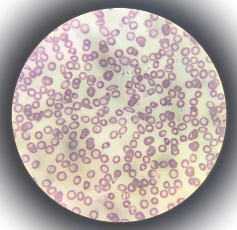 Abnormal Red Blood Cells Showing Spherocyte.Medical Science Background ...
