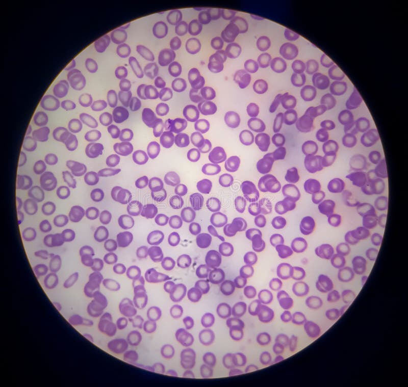 Blood Smear Under Microscope Showing Normal Red Cell Stock Photos ...