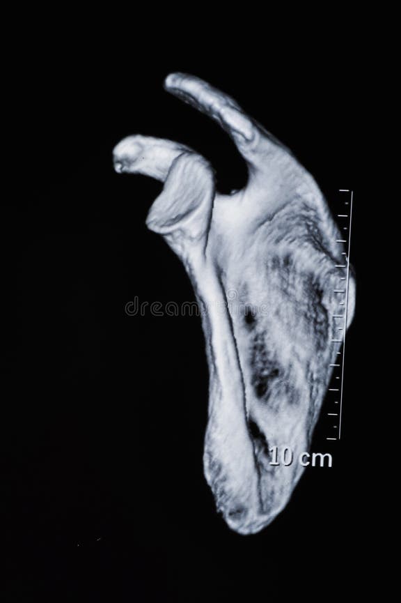 Human bone CT images stock photo. Image of bone, pain - 309580084