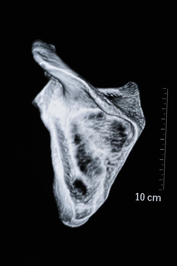 Human bone CT images stock illustration. Illustration of neurosurgery ...