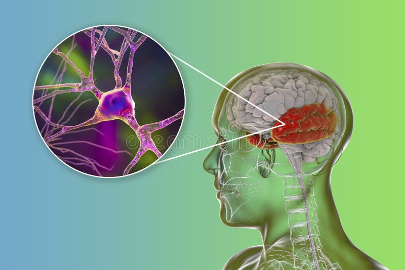 Human Brain with Highlighted Temporal Lobe and Close-up View of Neurons ...