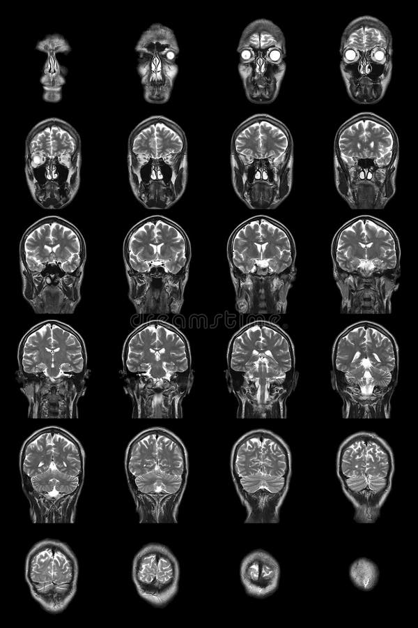 Normal Brain Mri Stock Photos - Free & Royalty-Free Stock Photos from ...