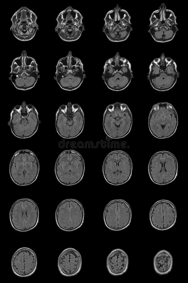 Human brain mri stock image. Image of diagnosis, head - 30503161