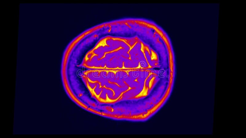 Human Brain Scan Mri Brain Scan Computed Tomography Of The Human