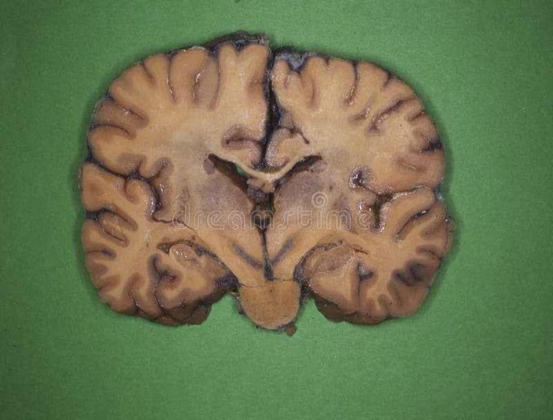 Human Brain Sliced with Nerves Stock Image - Image of skull, medicine ...