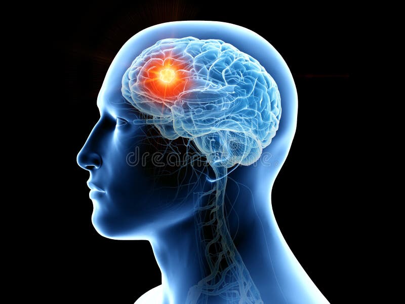 The Human Brain and a Tumor Stock Illustration - Illustration of ...