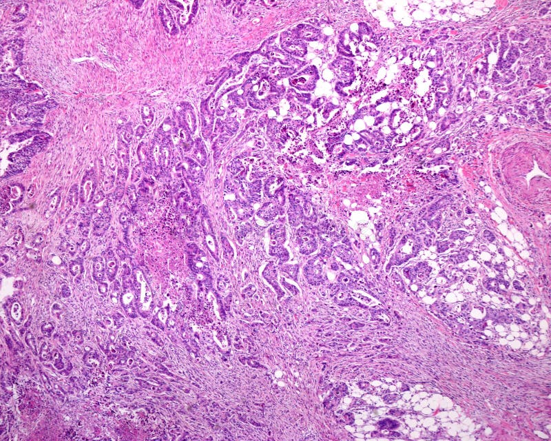 Human Breast. Malignant Carcinoma Stock Image - Image of ...