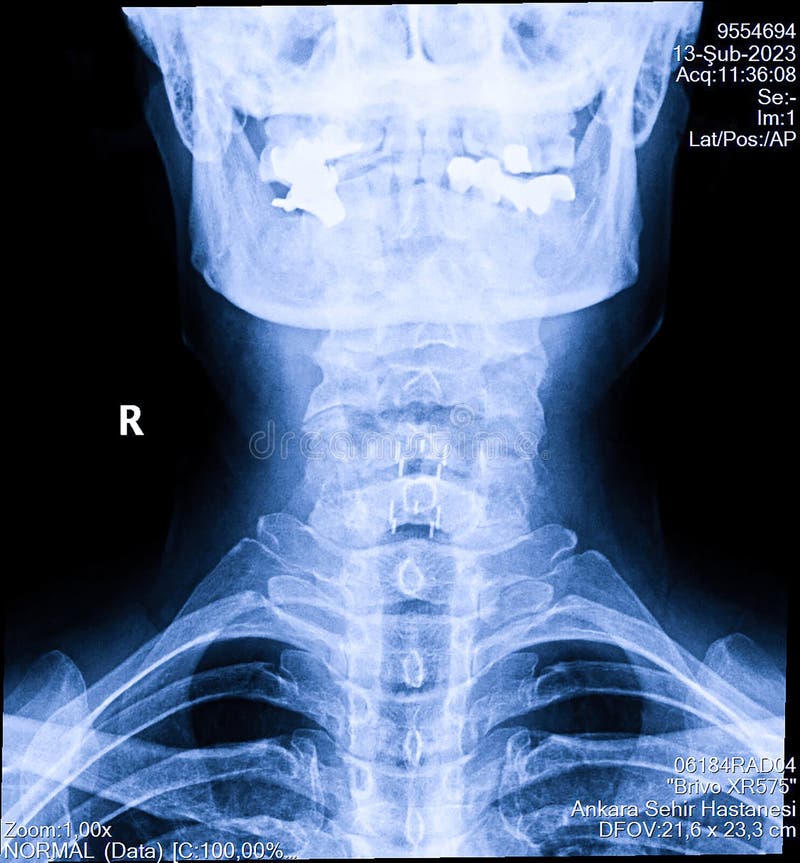 Human Cervical Spine X-ray, Neck Radiography Stock Image - Image of ...