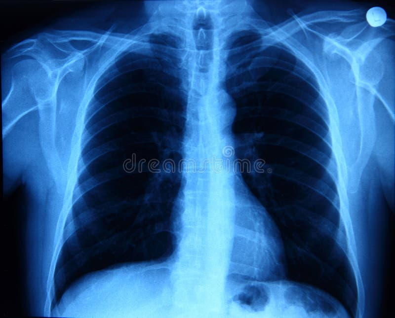 Human chest stock photo. Image of exam, clinic, blue - 17377484