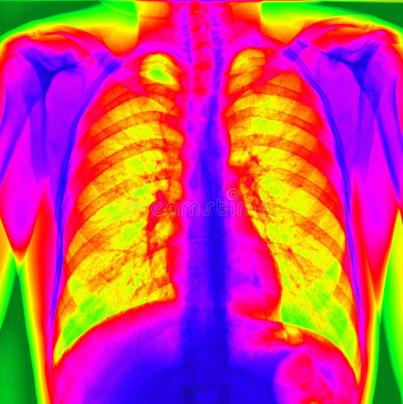 Human chest stock image. Image of bronchus, anterior - 67806785