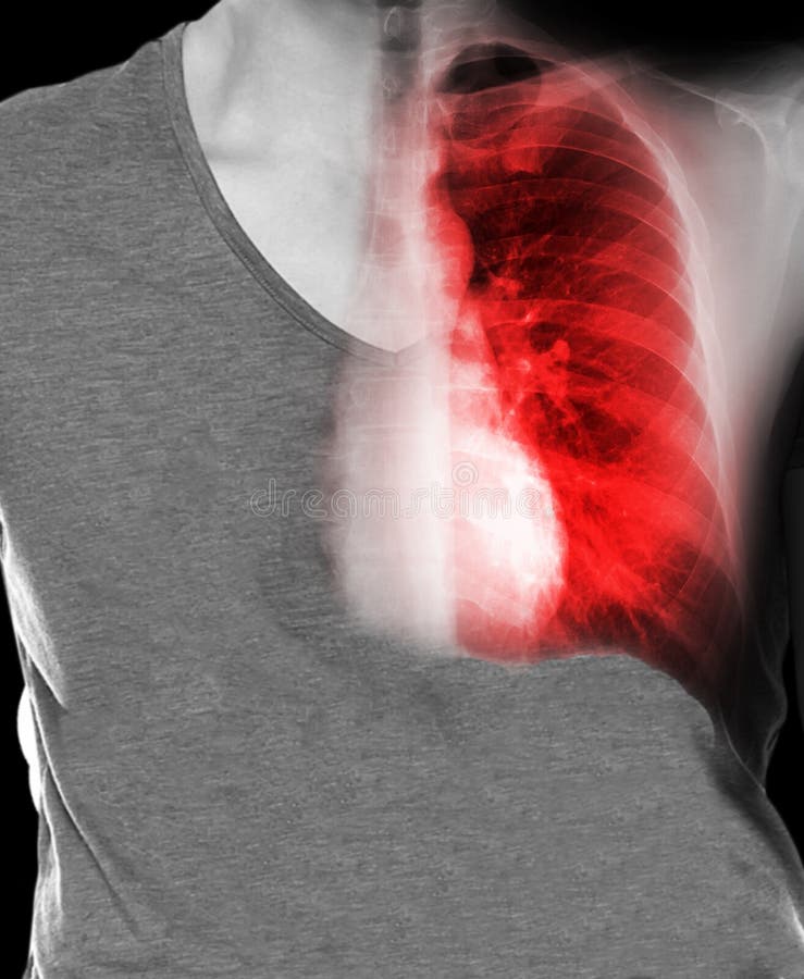 Human Chest with X-ray Chest Imaging Stock Image - Image of medicine ...