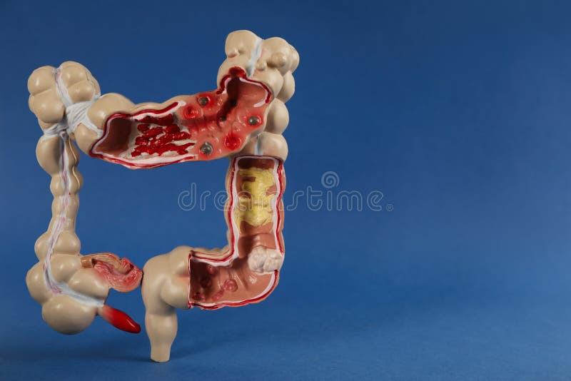 Human Colon Model on Blue Background. Space for Text Stock Photo ...