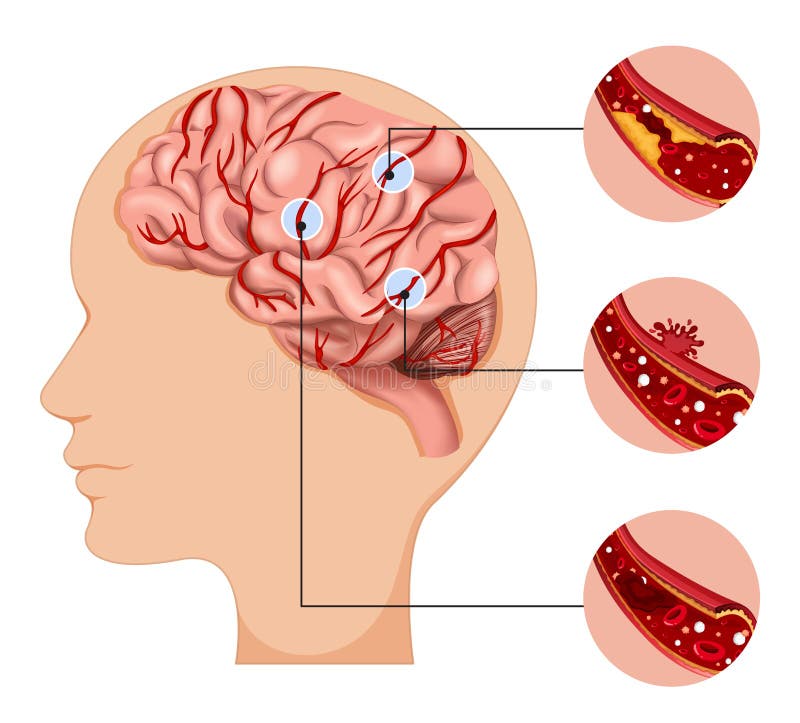 Human with Common Types of Stroke Infographic Stock Vector ... Human with Common Types of Stroke Infographic Stock Vector ...