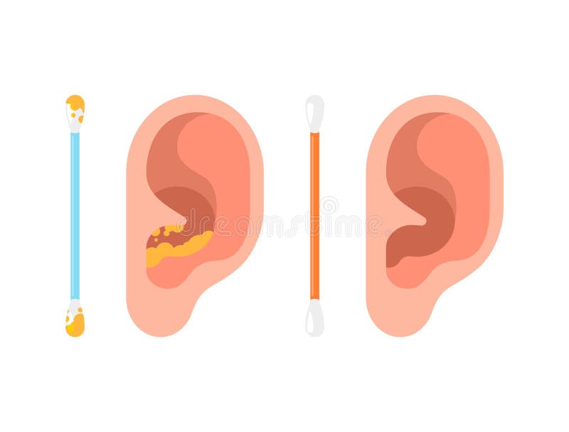Human Ear and Ear Stick. Ear Cleaning Stick Stock Vector - Illustration ...