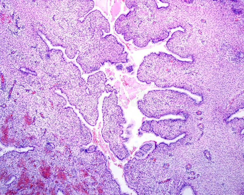 Human endocervical polyp stock image. Image of histology - 379802407