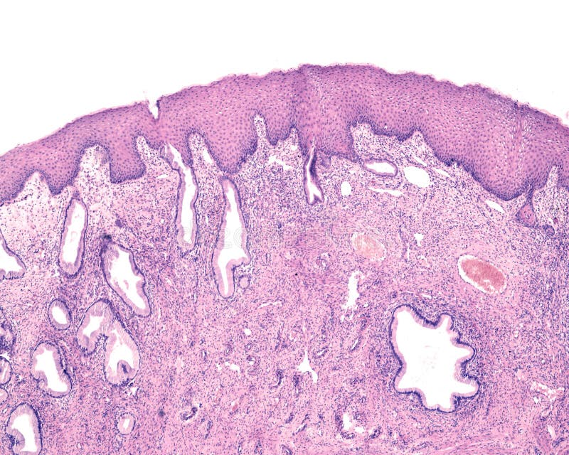 Metaplasia For Pinterest Appearance Of Intestinal Metaplasia Lesions