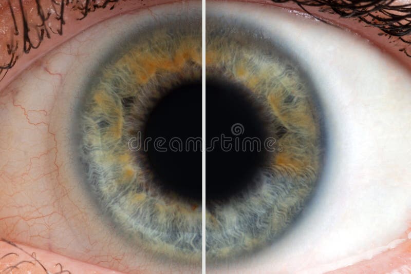 Human Eye with Blood Vessels before and after Stock Image - Image of ...