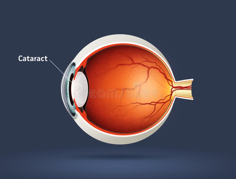 Human eye - cataract stock illustration. Illustration of macula - 5501221