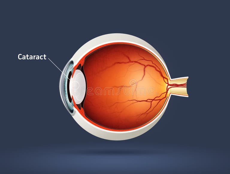 Cataract Human Eye Disease Stock Illustrations – 789 Cataract Human Eye ...