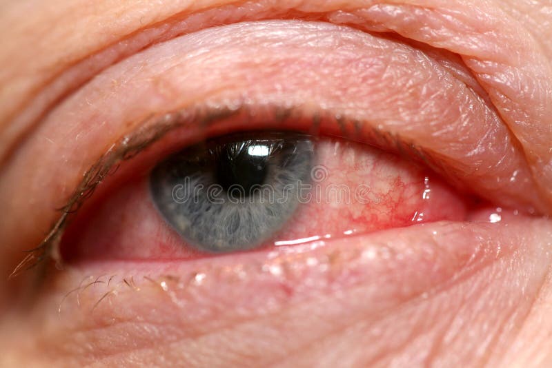 Human Eye with Conjunctivitis Stock Image - Image of horizontal, pink ...