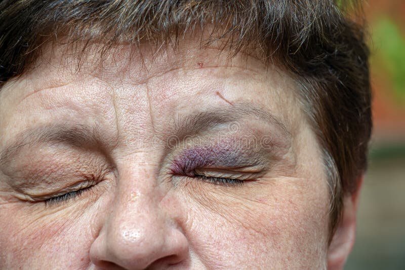 A Human Eye with a Large Black-violet Bruise. Swelling Due To Bruise ...