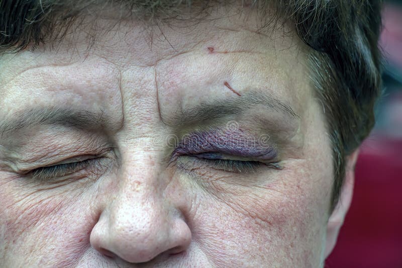 A Human Eye with a Large Black-violet Bruise. Swelling Due To Bruise ...
