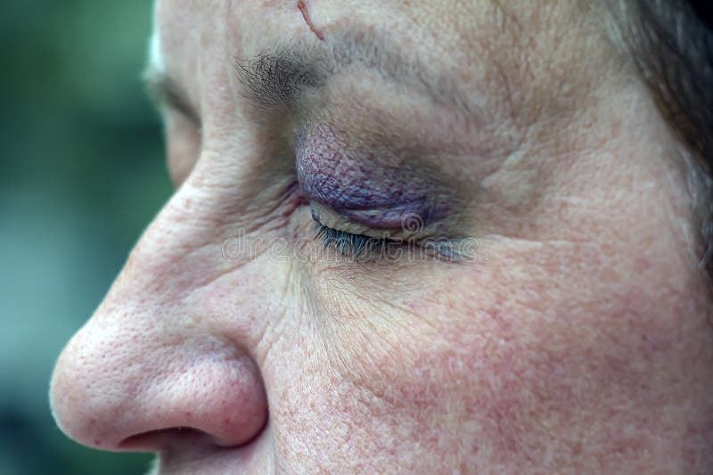 A Human Eye with a Large Black-violet Bruise. Swelling Due To Bruise ...