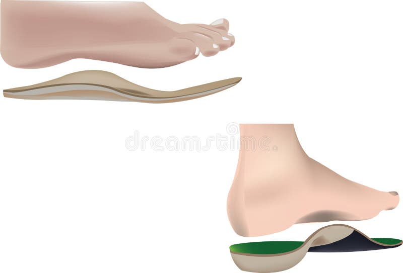 Human Feet with Use of Insoles- Stock Photo - Image of support, therapy ...