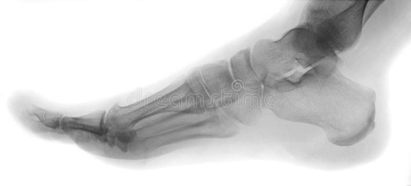 Human Foot stock image. Image of care, side, orthopedic - 37856829