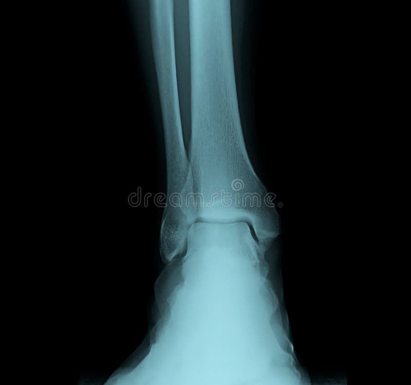 The Bend Of Leg And Foot X Ray