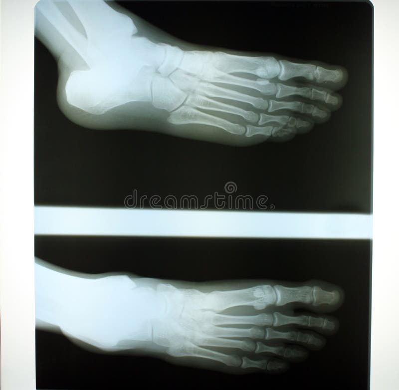 Human foot x-ray stock photo. Image of foot, resolution - 18787876