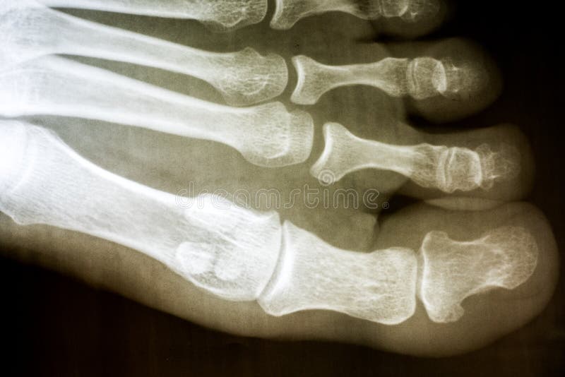 Human Foot X-Ray stock photo. Image of body, radiation - 46837654