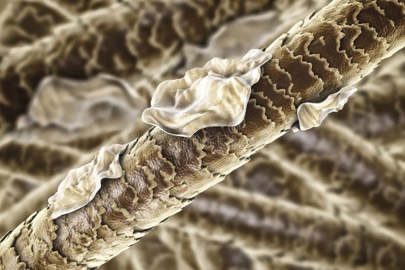 Dandruff on Human Hairs and Skin Stock Illustration - Illustration of ...