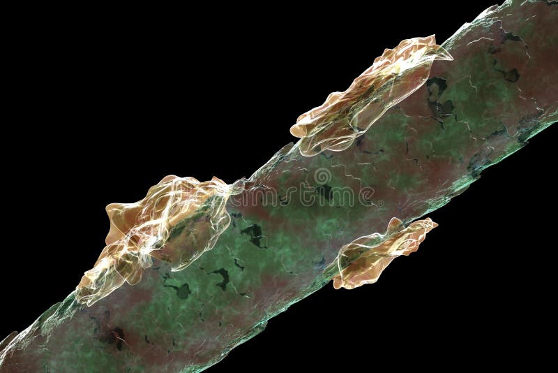 Dandruff on Human Hairs and Skin Stock Illustration - Illustration of ...