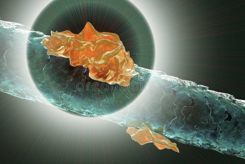 Dandruff on Human Hairs and Skin Stock Illustration - Illustration of ...