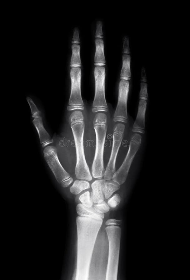 X-ray of human hand stock image. Image of arthritis, anatomy - 22870485