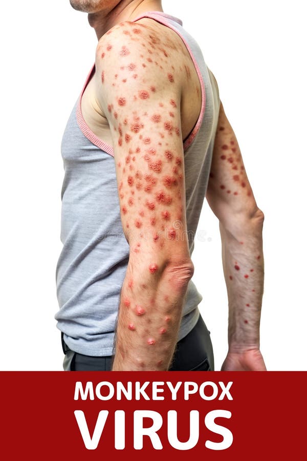Multiple Pustules Stock Photos - Free & Royalty-Free Stock Photos from ...