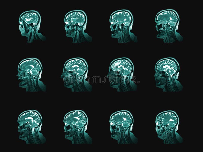 Human Head and Brain Computer Tomography Image Set. Vertical Partition ...
